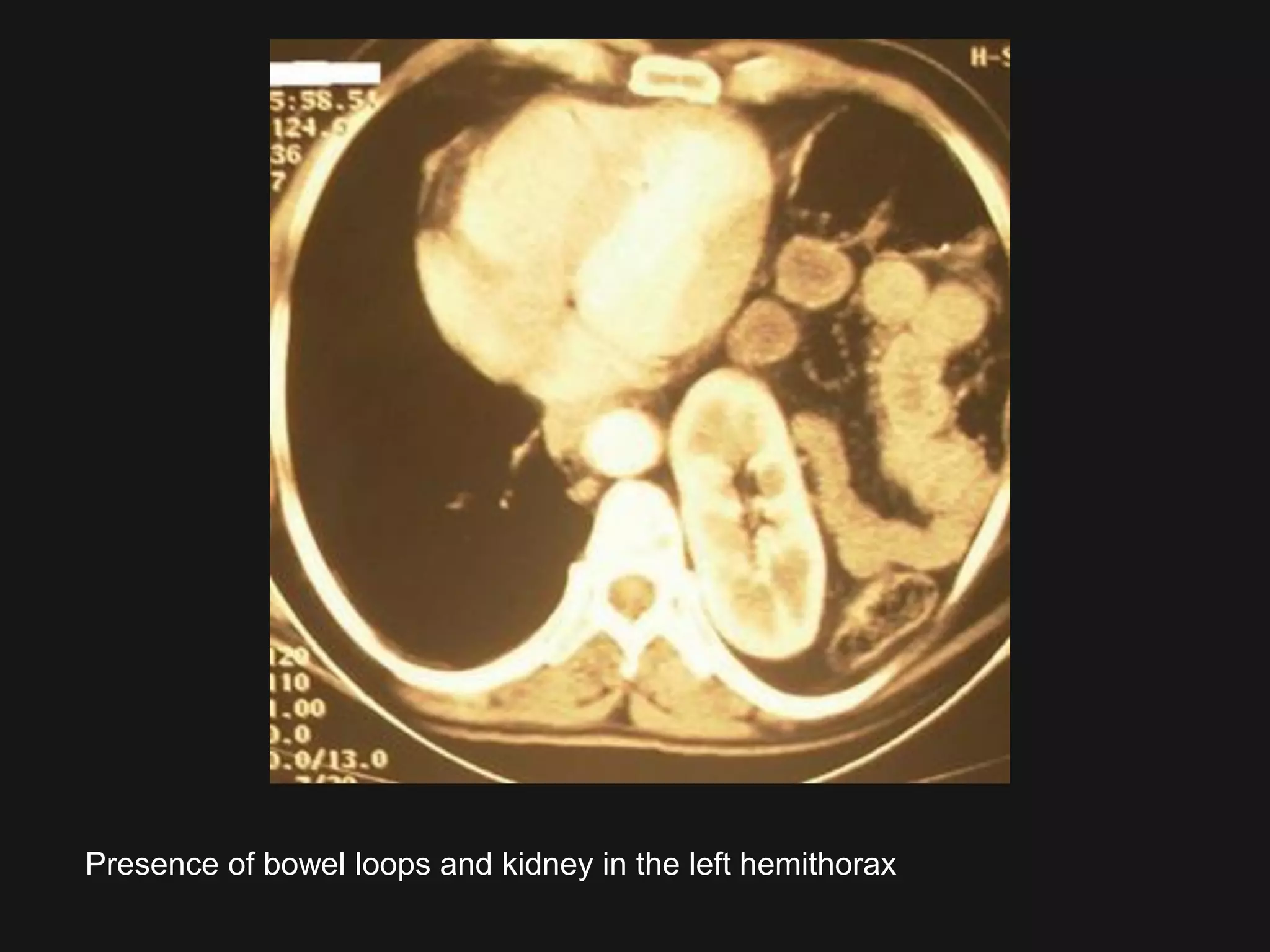 Imaging abdomen trauma diaphragmatic trauma part 7 Dr Ahmed Esawy | PDF