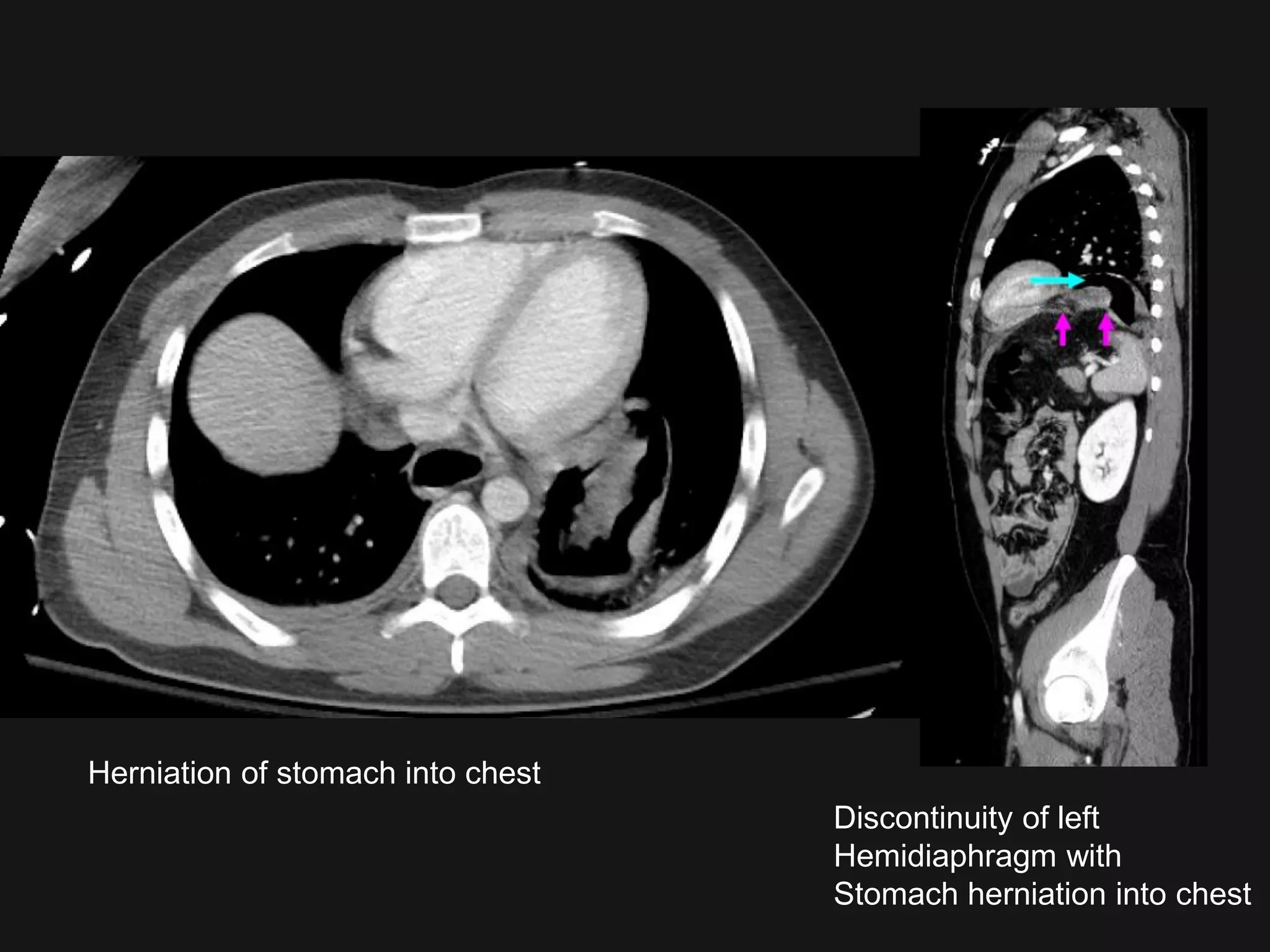 Imaging abdomen trauma diaphragmatic trauma part 7 Dr Ahmed Esawy | PDF