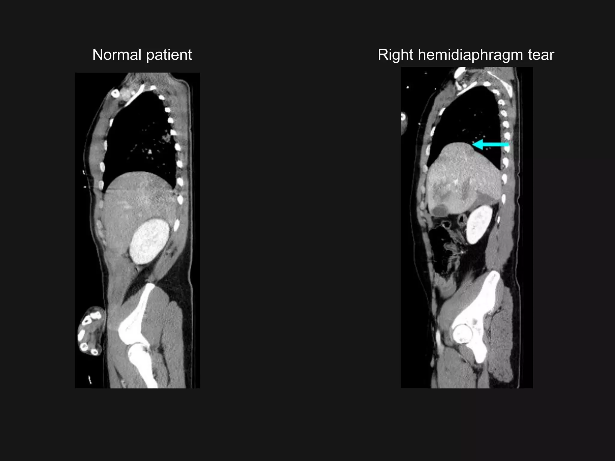 Imaging abdomen trauma diaphragmatic trauma part 7 Dr Ahmed Esawy | PDF