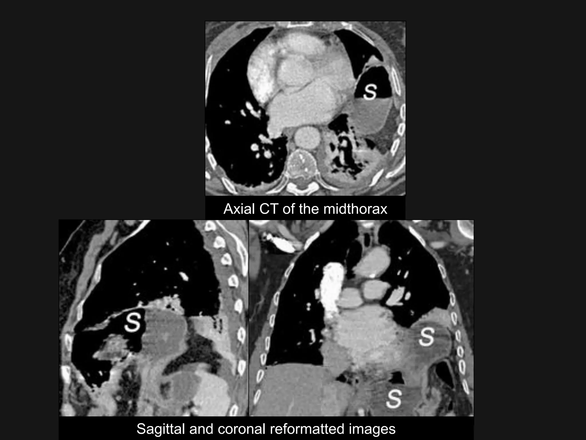 Imaging abdomen trauma diaphragmatic trauma part 7 Dr Ahmed Esawy | PDF