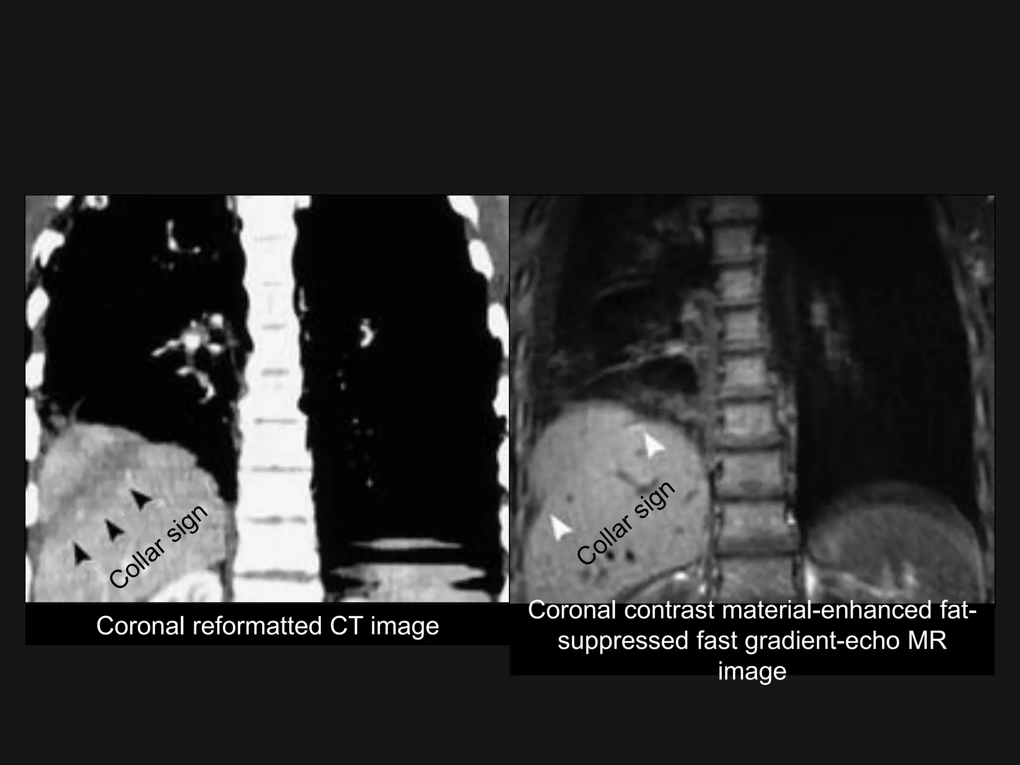 Imaging abdomen trauma diaphragmatic trauma part 7 Dr Ahmed Esawy | PDF