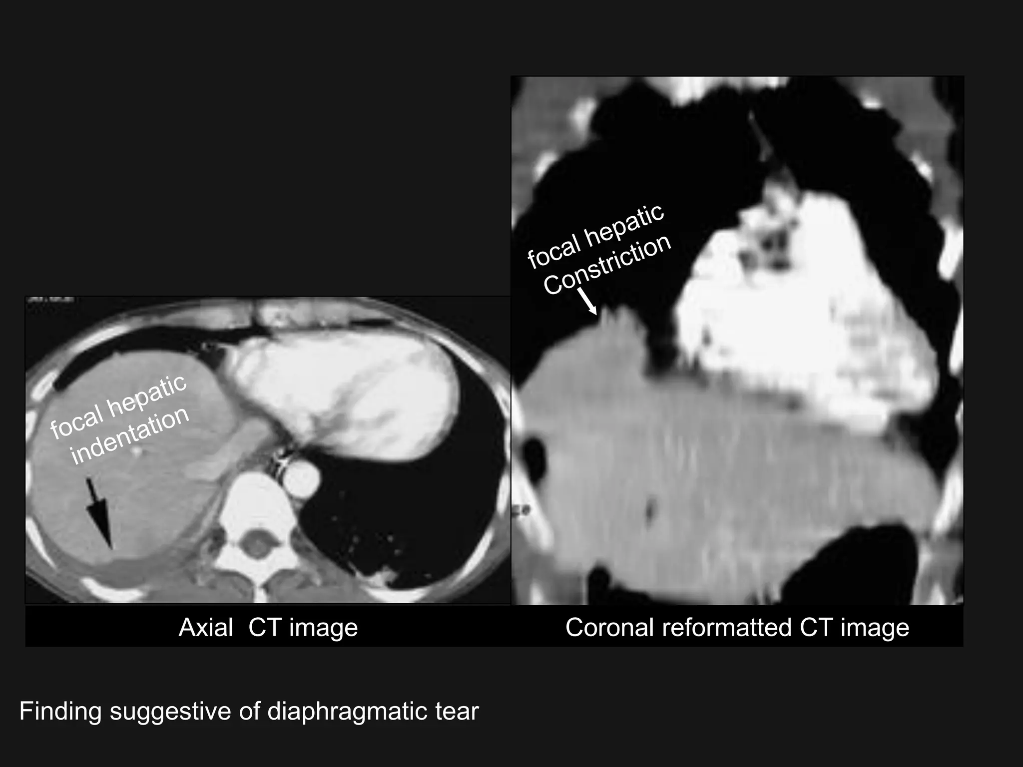 Imaging abdomen trauma diaphragmatic trauma part 7 Dr Ahmed Esawy | PDF