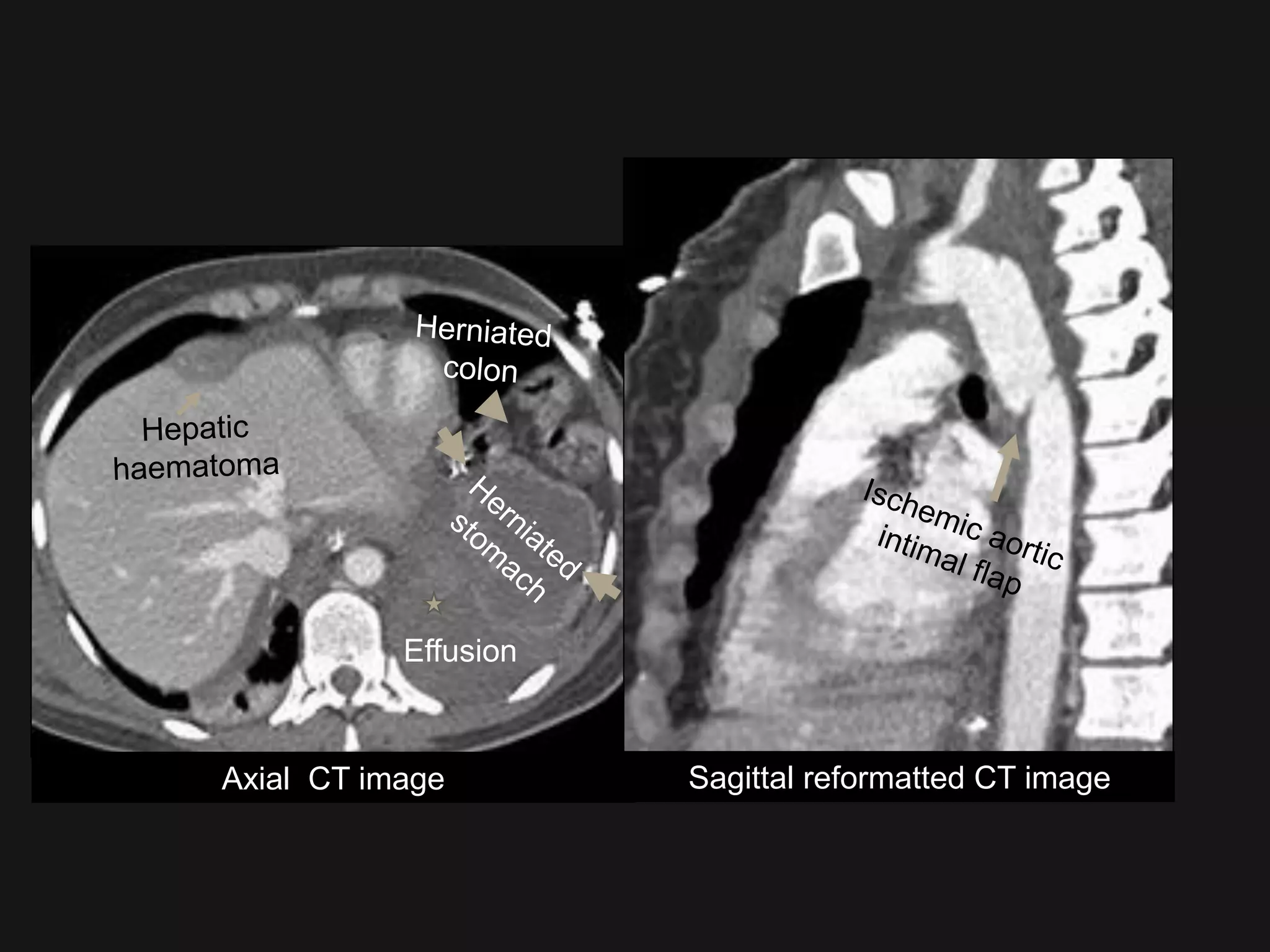Imaging abdomen trauma diaphragmatic trauma part 7 Dr Ahmed Esawy | PDF