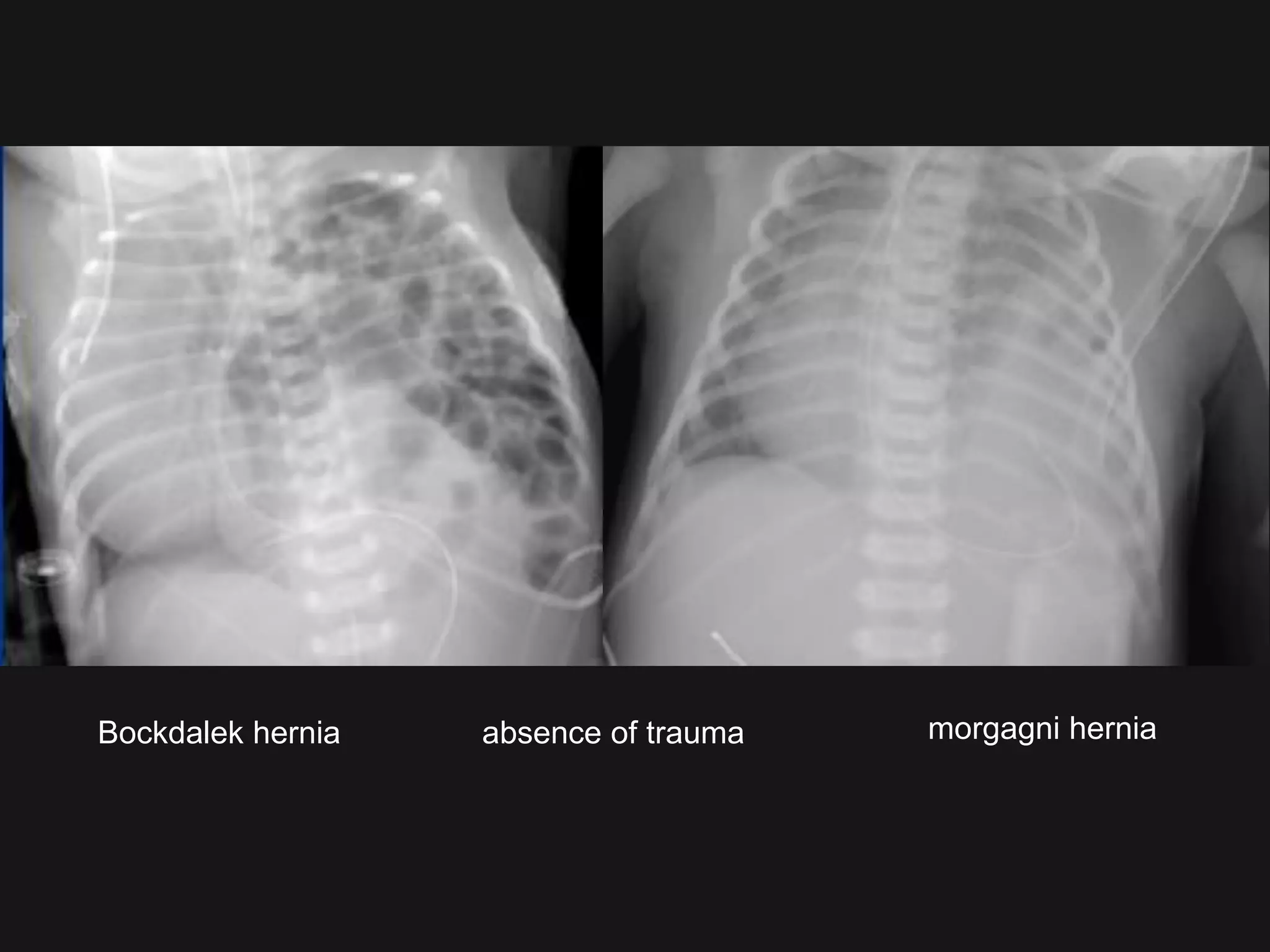 Imaging abdomen trauma diaphragmatic trauma part 7 Dr Ahmed Esawy | PDF