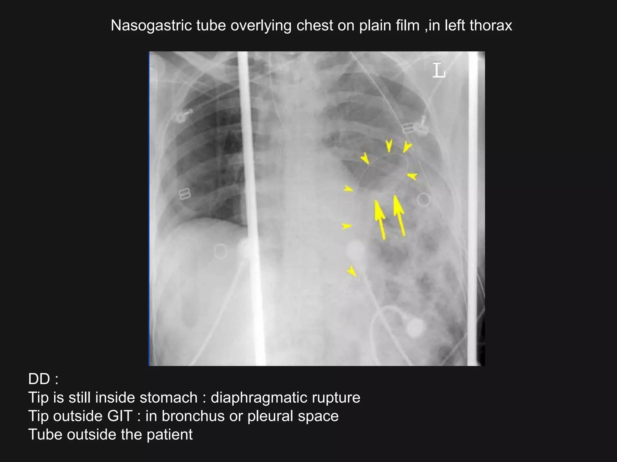 Imaging abdomen trauma diaphragmatic trauma part 7 Dr Ahmed Esawy | PDF
