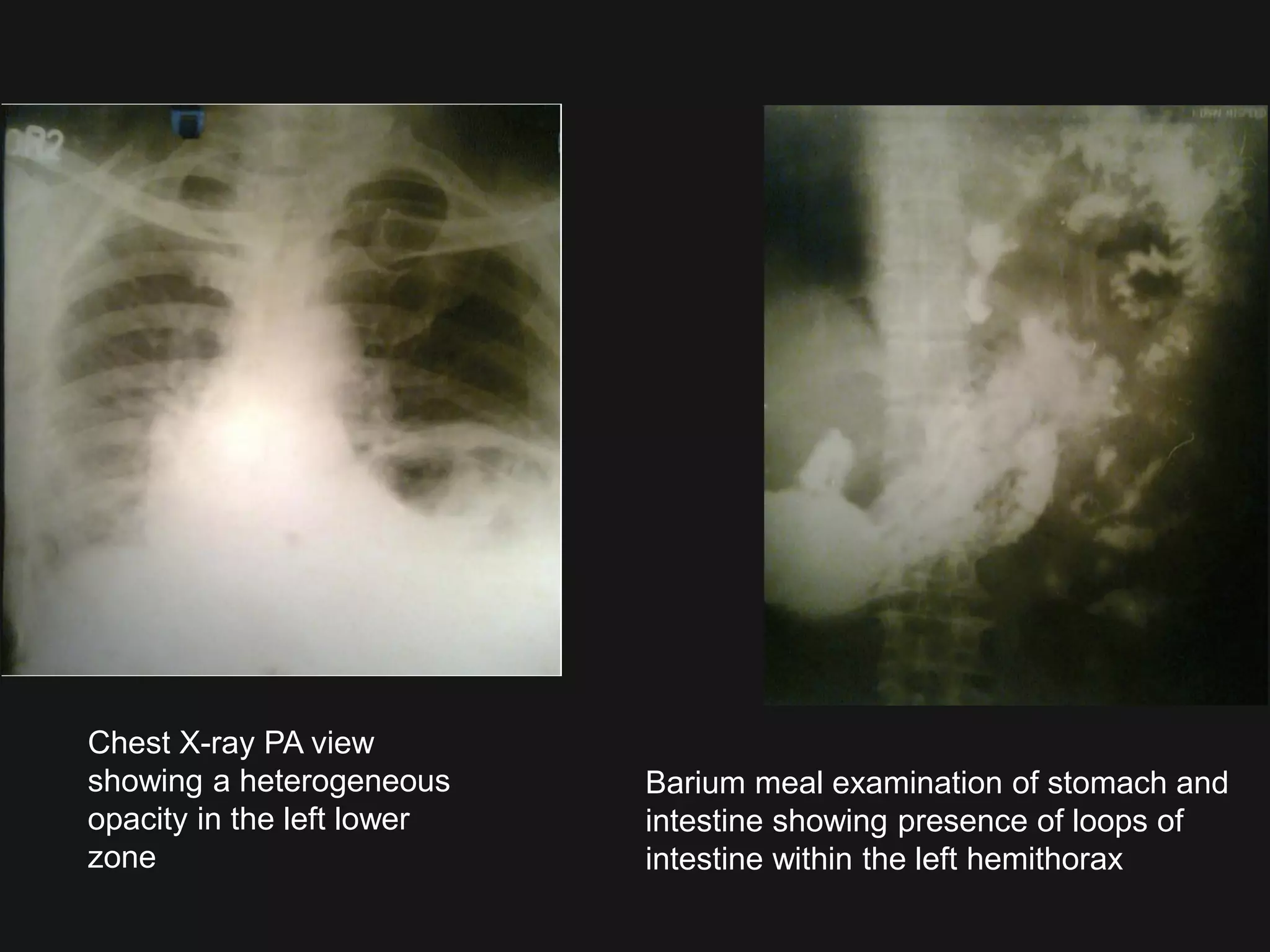 Imaging abdomen trauma diaphragmatic trauma part 7 Dr Ahmed Esawy | PDF