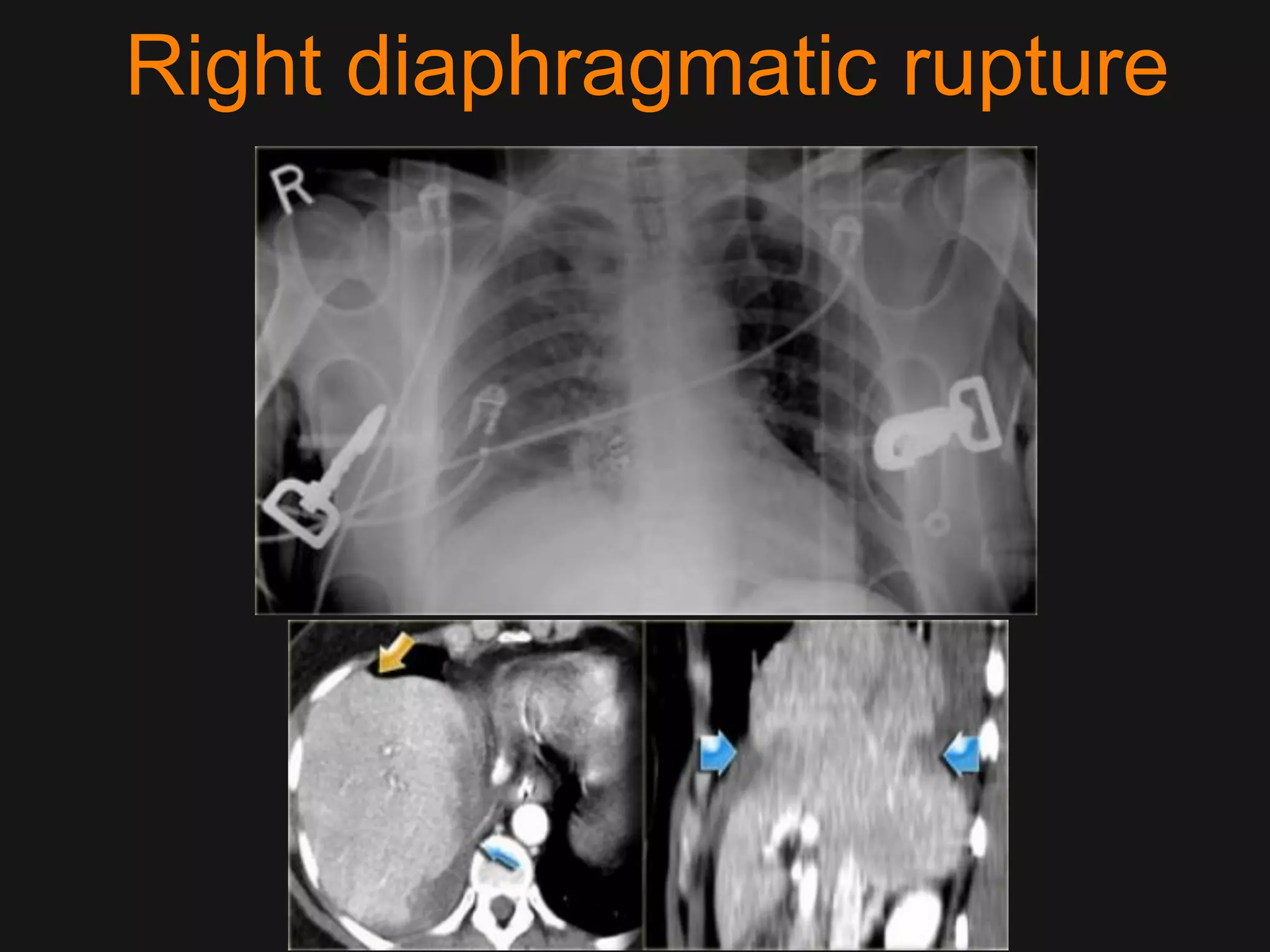 Imaging abdomen trauma diaphragmatic trauma part 7 Dr Ahmed Esawy | PDF