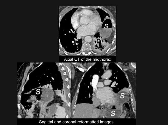 Imaging abdomen trauma diaphragmatic trauma part 7 Dr Ahmed Esawy | PPT