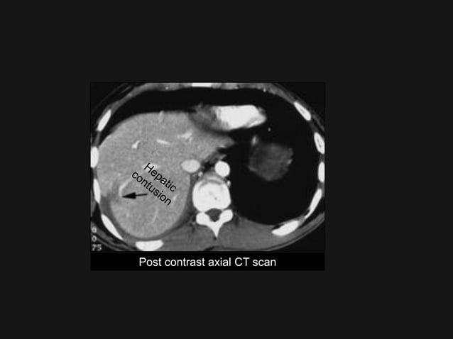 Imaging abdomen trauma diaphragmatic trauma part 7 Dr Ahmed Esawy | PPT