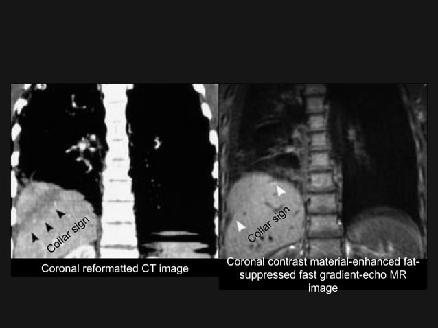 Imaging abdomen trauma diaphragmatic trauma part 7 Dr Ahmed Esawy | PPT
