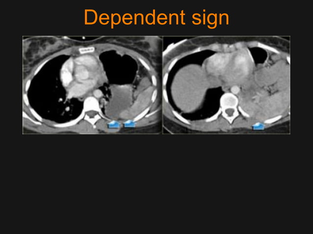 Imaging abdomen trauma diaphragmatic trauma part 7 Dr Ahmed Esawy | PPT