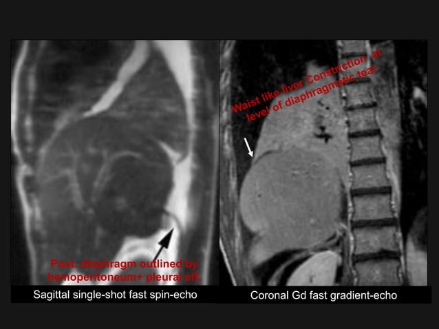 Imaging abdomen trauma diaphragmatic trauma part 7 Dr Ahmed Esawy | PPT