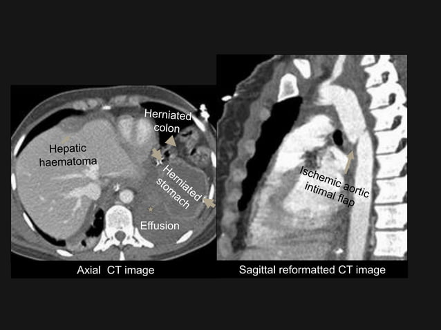 Imaging abdomen trauma diaphragmatic trauma part 7 Dr Ahmed Esawy | PPT