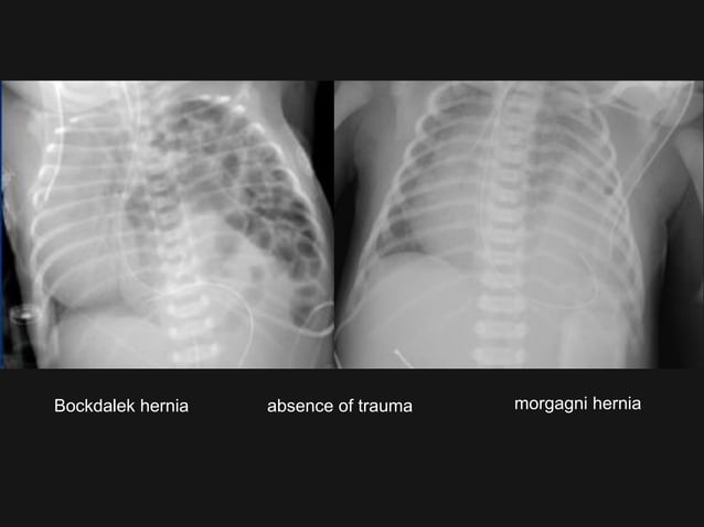 Imaging abdomen trauma diaphragmatic trauma part 7 Dr Ahmed Esawy | PPT