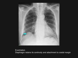 Imaging abdomen trauma diaphragmatic trauma part 7 Dr Ahmed Esawy | PDF