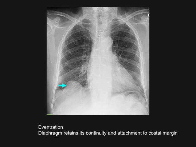 Imaging abdomen trauma diaphragmatic trauma part 7 Dr Ahmed Esawy | PPT