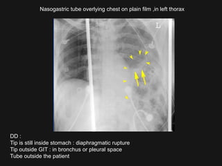 Imaging abdomen trauma diaphragmatic trauma part 7 Dr Ahmed Esawy | PDF