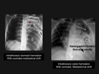 Imaging abdomen trauma diaphragmatic trauma part 7 Dr Ahmed Esawy | PDF