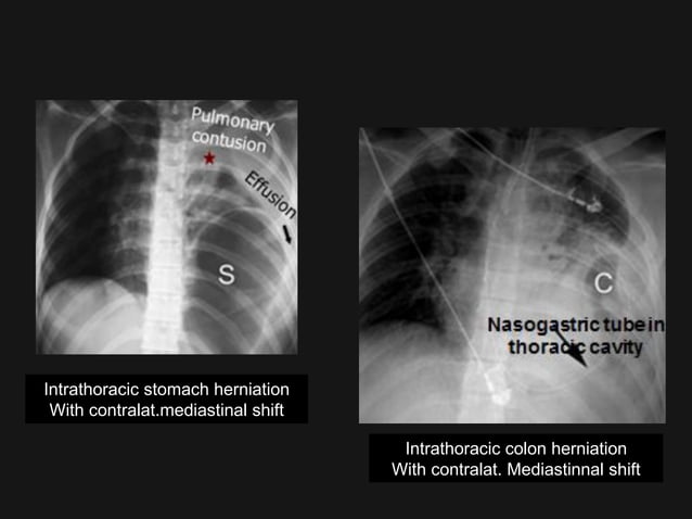 Imaging abdomen trauma diaphragmatic trauma part 7 Dr Ahmed Esawy | PPT