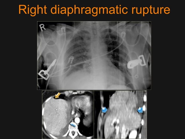 Imaging abdomen trauma diaphragmatic trauma part 7 Dr Ahmed Esawy | PPT