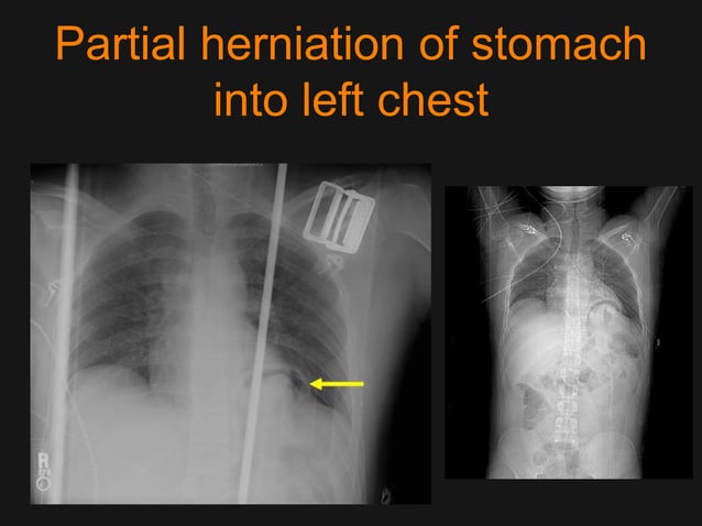 Imaging abdomen trauma diaphragmatic trauma part 7 Dr Ahmed Esawy | PPT
