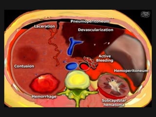 Imaging abdomen trauma introduction part 1 Dr Ahmed Esawy | PDF