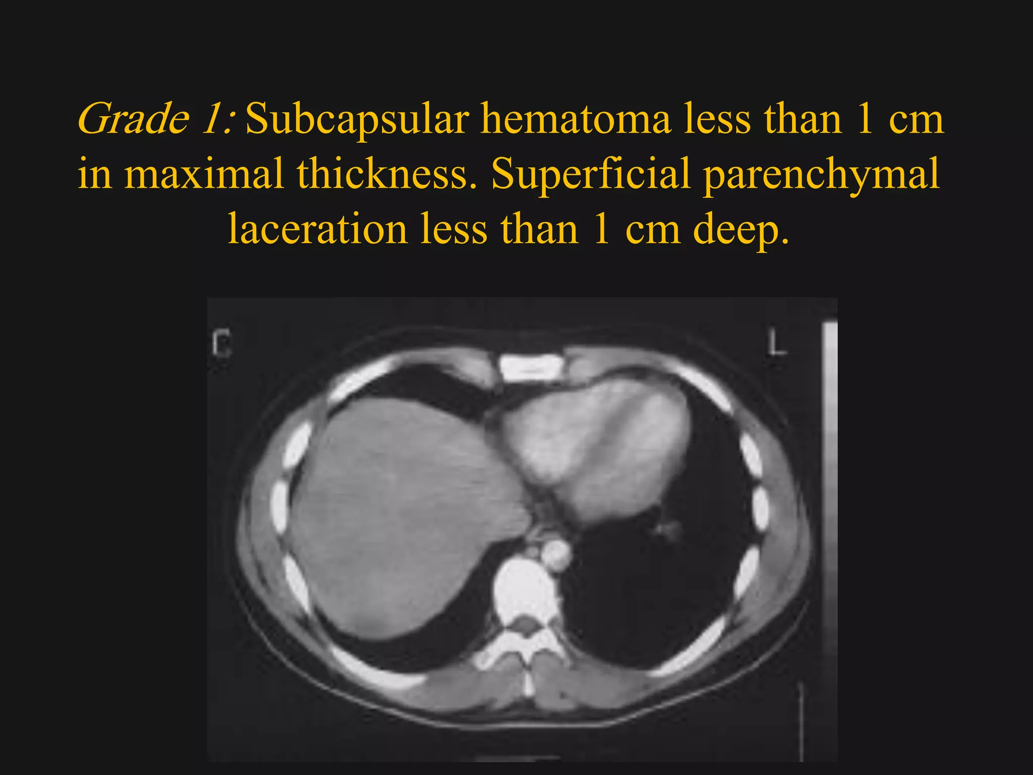Imaging abdomen trauma liver part 2 Dr Ahmed Esawy | PDF