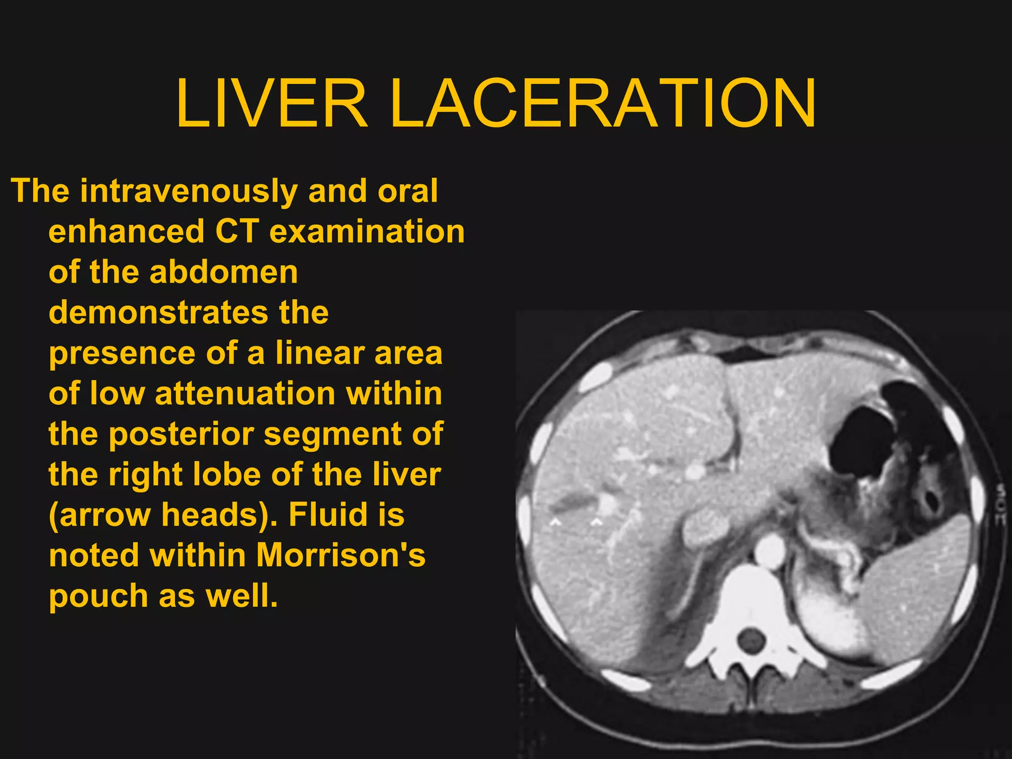 Imaging abdomen trauma liver part 2 Dr Ahmed Esawy | PDF