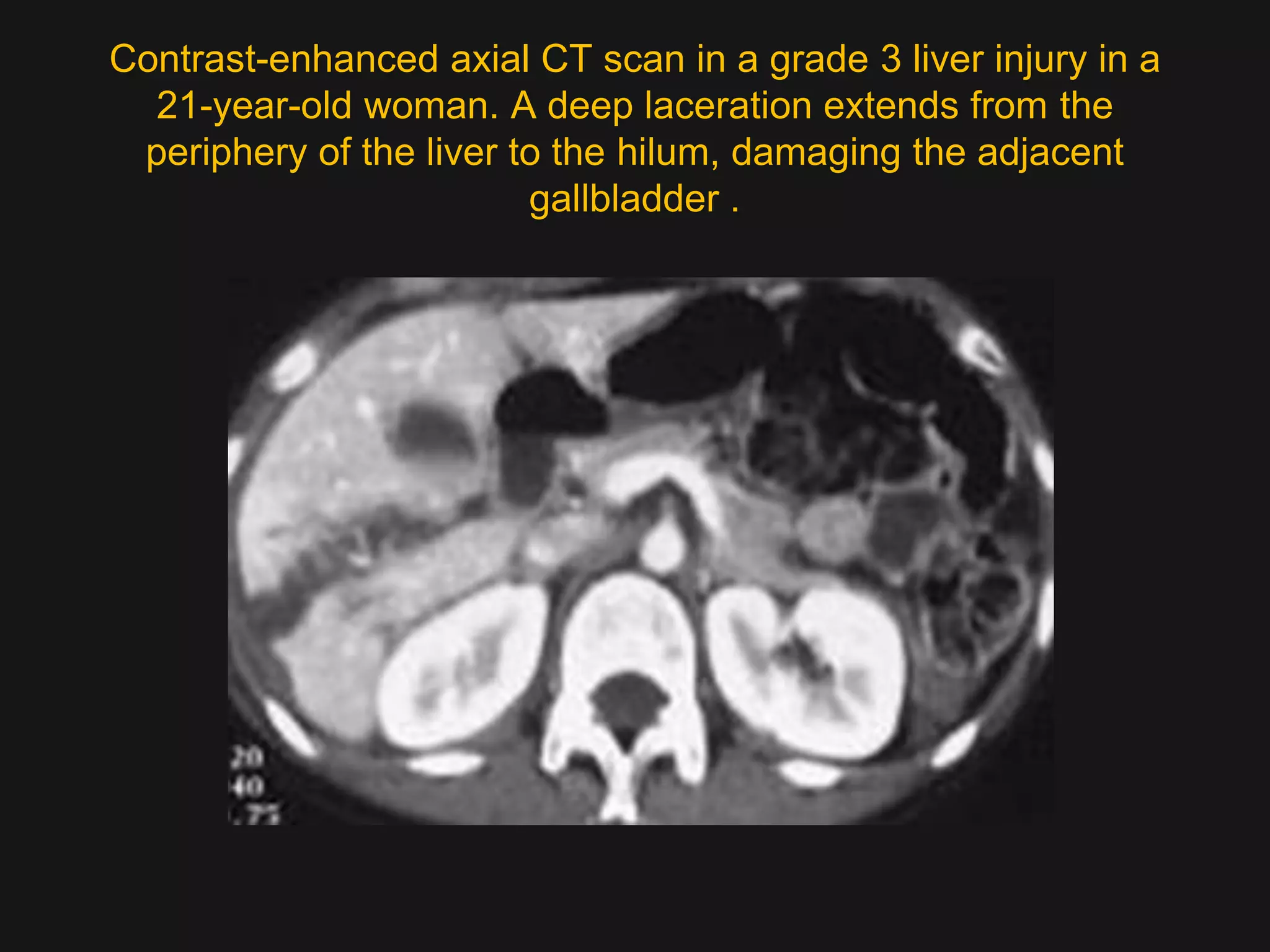 Imaging abdomen trauma liver part 2 Dr Ahmed Esawy | PDF