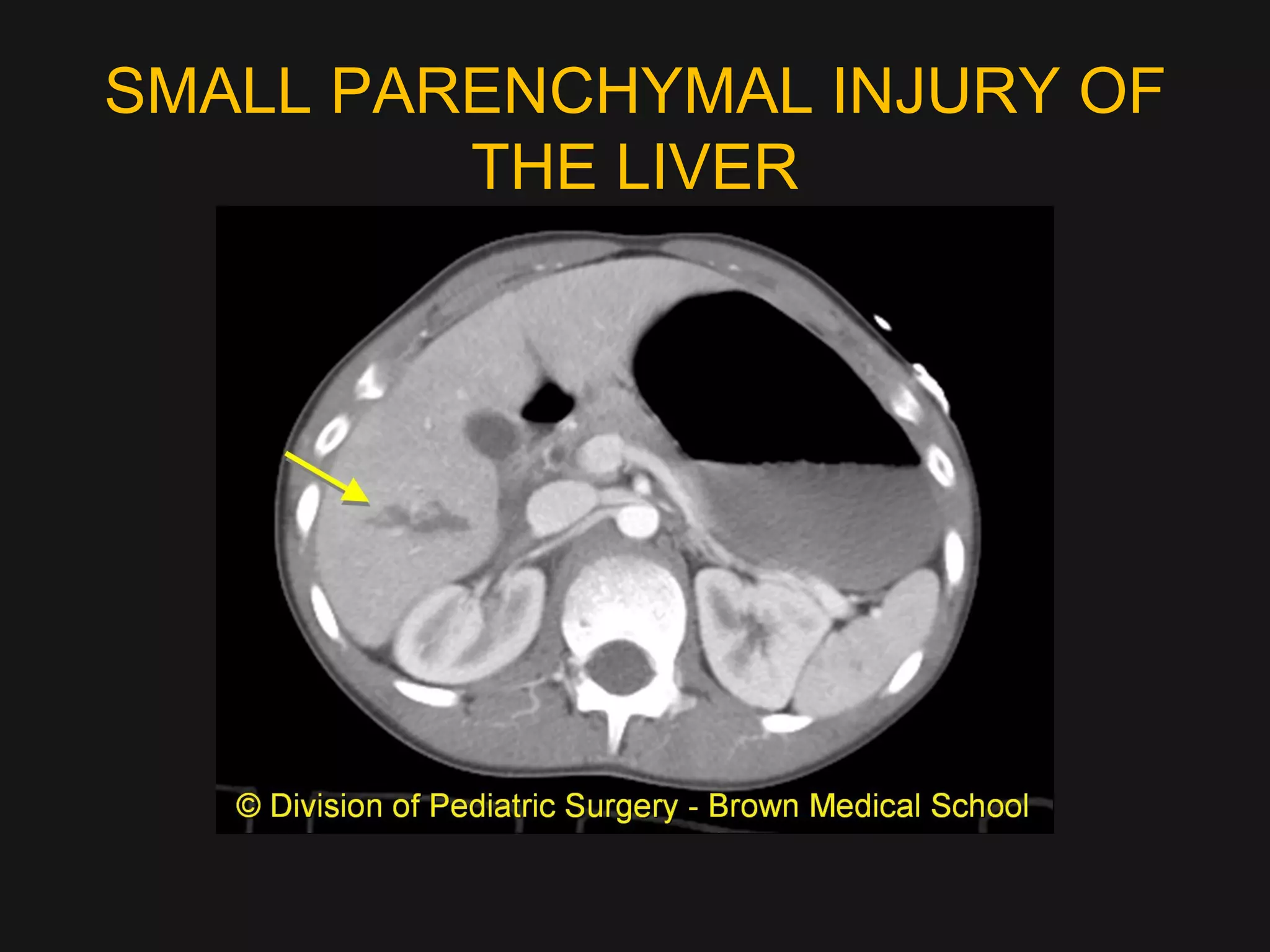 Imaging abdomen trauma liver part 2 Dr Ahmed Esawy | PDF