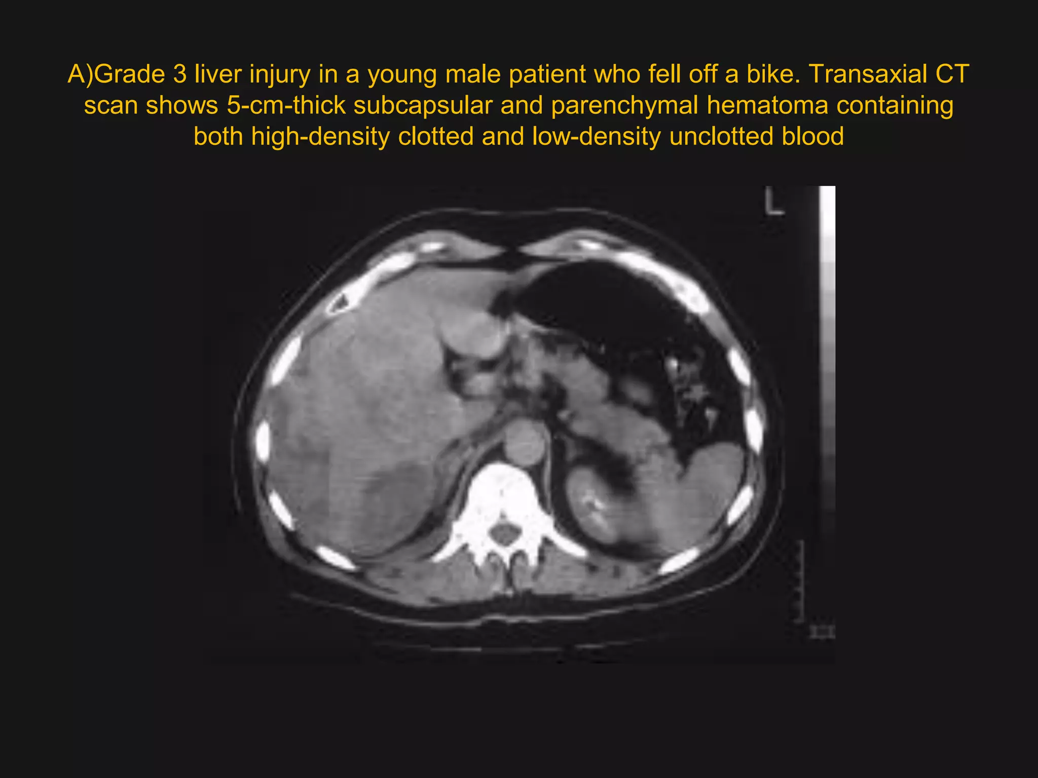 Imaging abdomen trauma liver part 2 Dr Ahmed Esawy | PDF