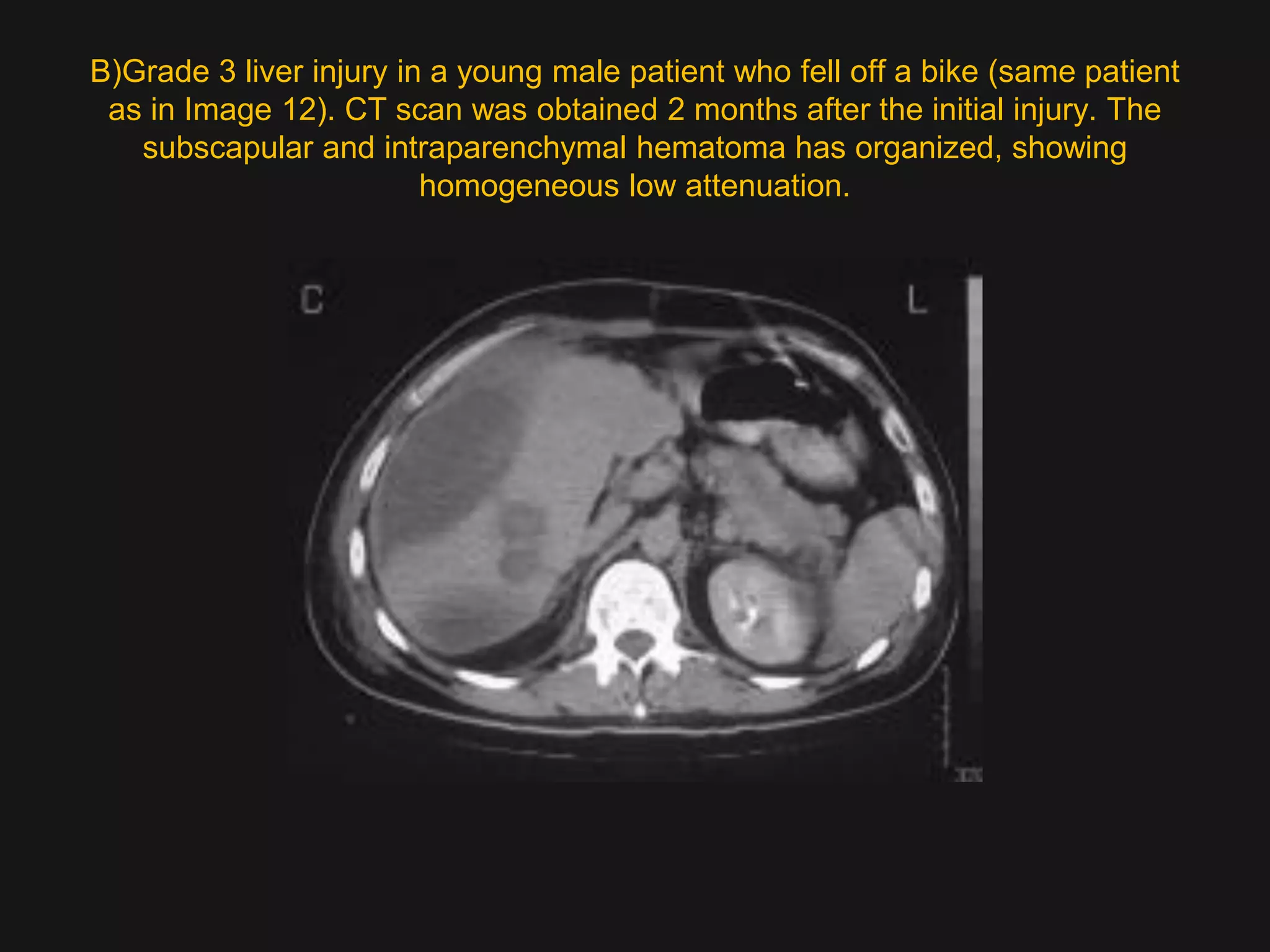 Imaging abdomen trauma liver part 2 Dr Ahmed Esawy | PDF