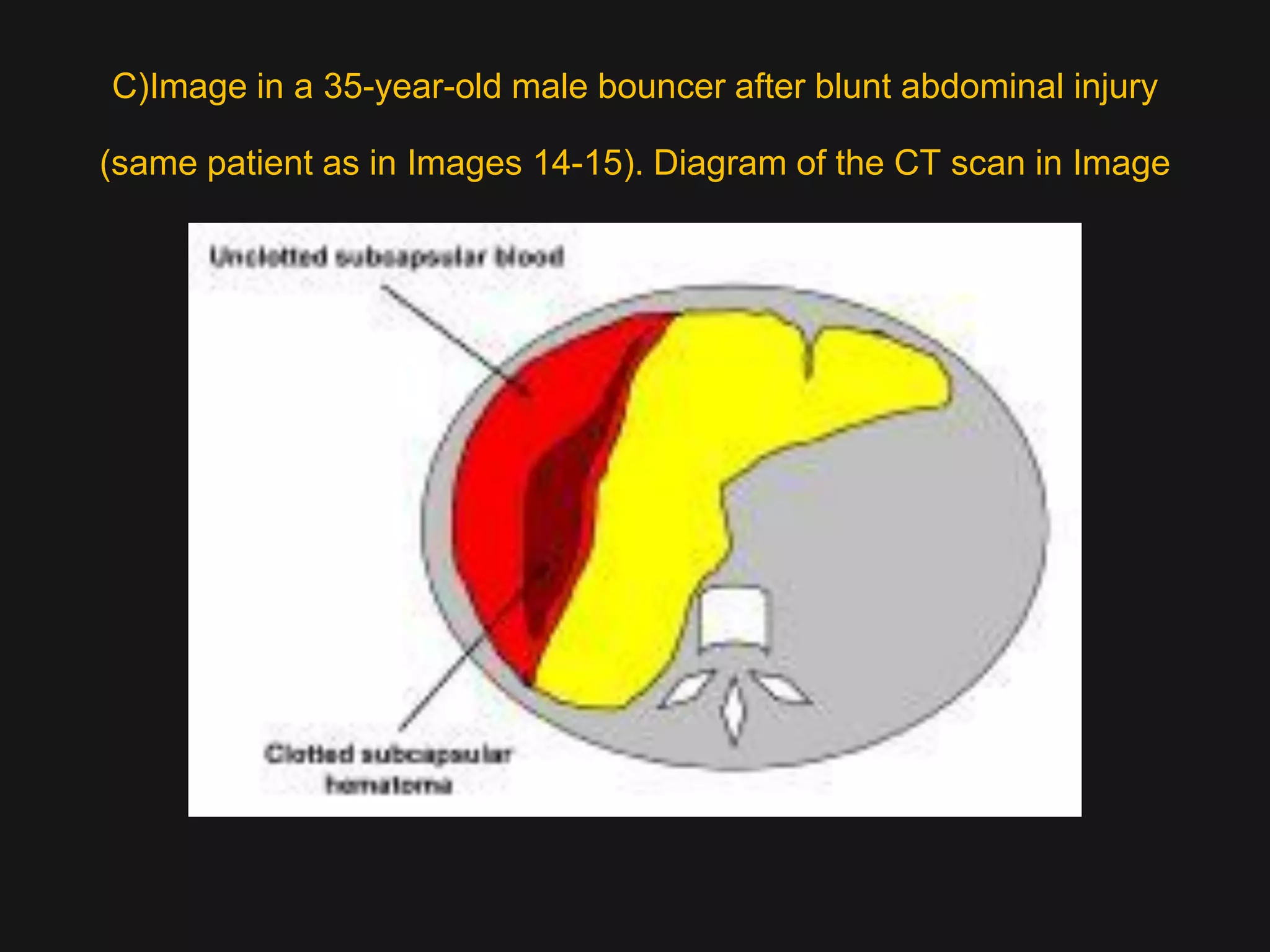 Imaging abdomen trauma liver part 2 Dr Ahmed Esawy | PDF