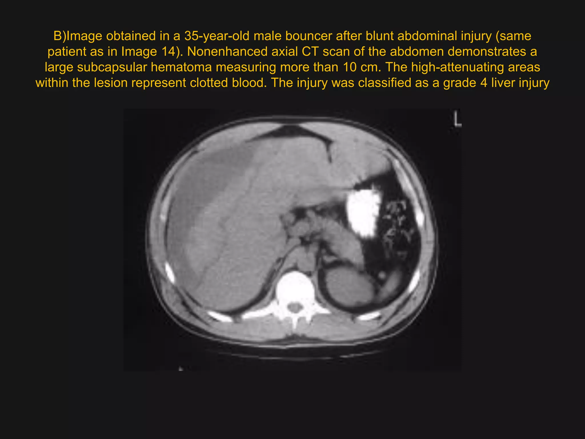Imaging abdomen trauma liver part 2 Dr Ahmed Esawy | PDF