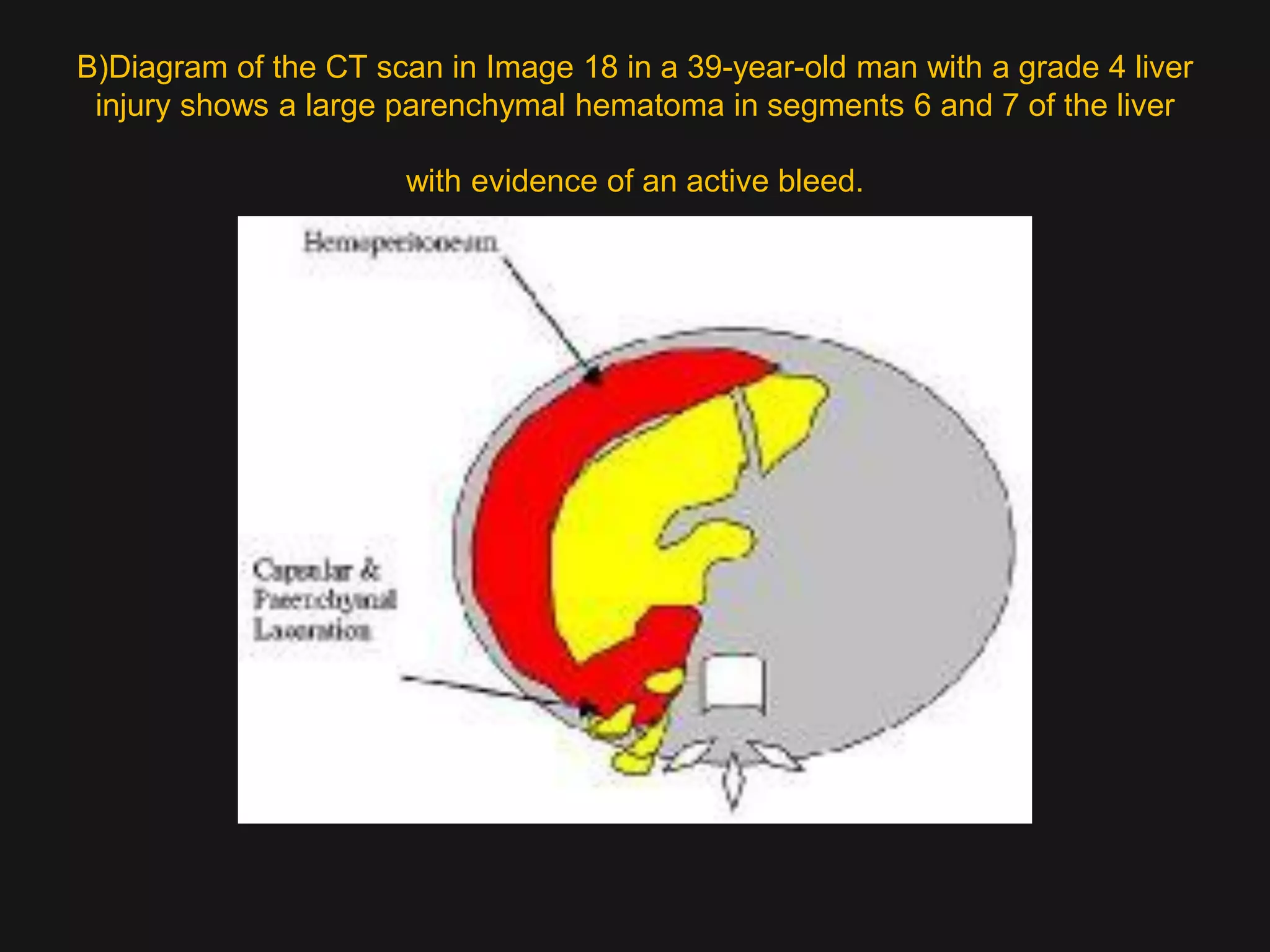 Imaging abdomen trauma liver part 2 Dr Ahmed Esawy | PDF