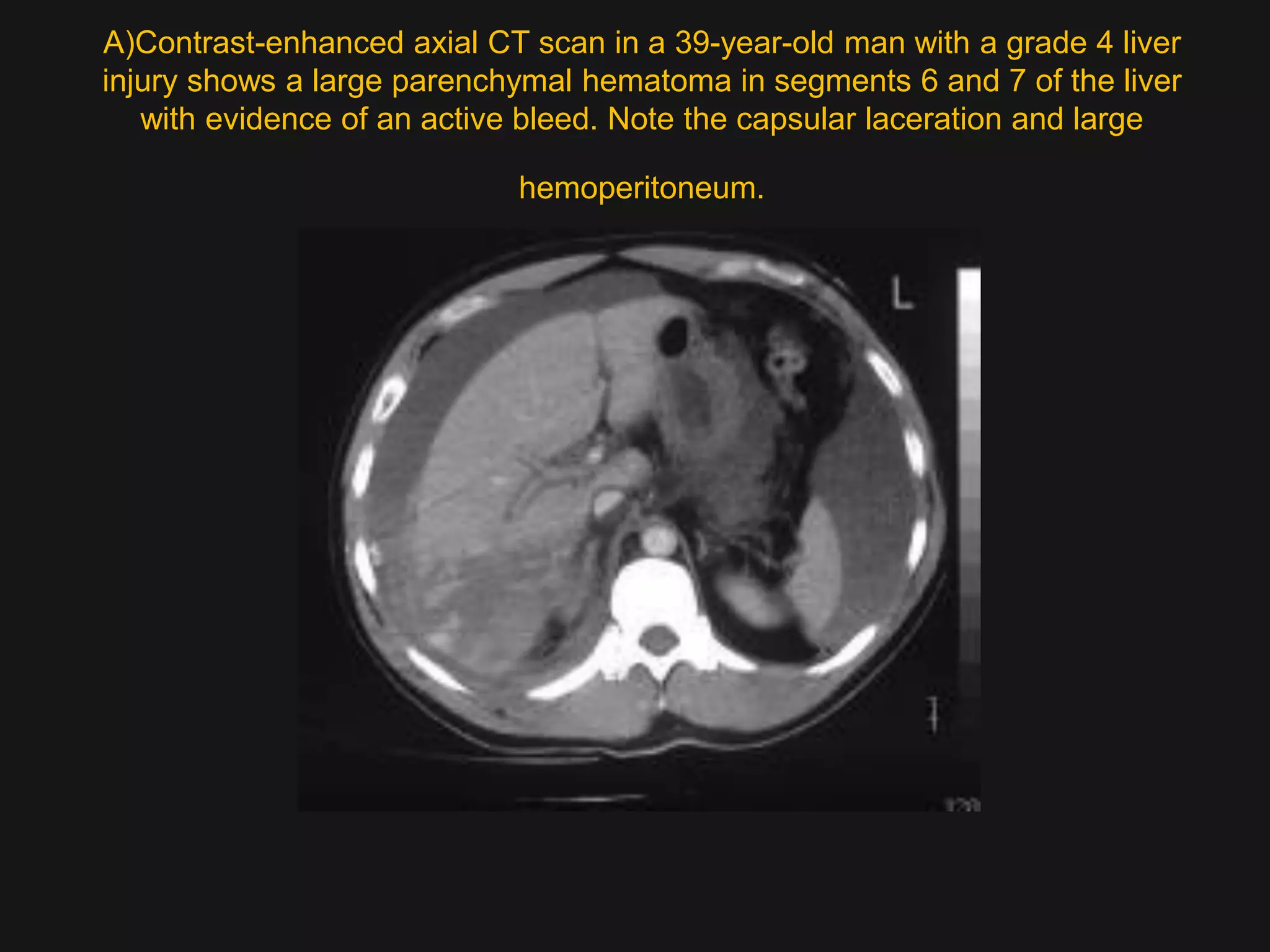 Imaging abdomen trauma liver part 2 Dr Ahmed Esawy | PDF