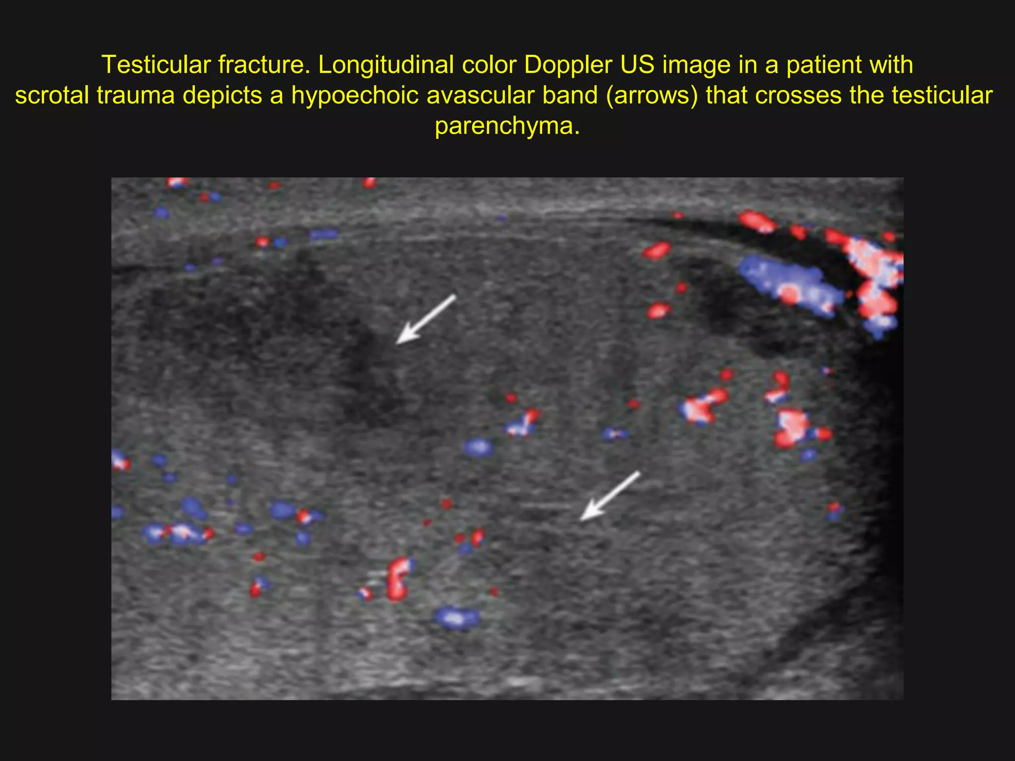 Imaging abdomen trauma male geniital part 10 Dr Ahmed Esawy | PDF
