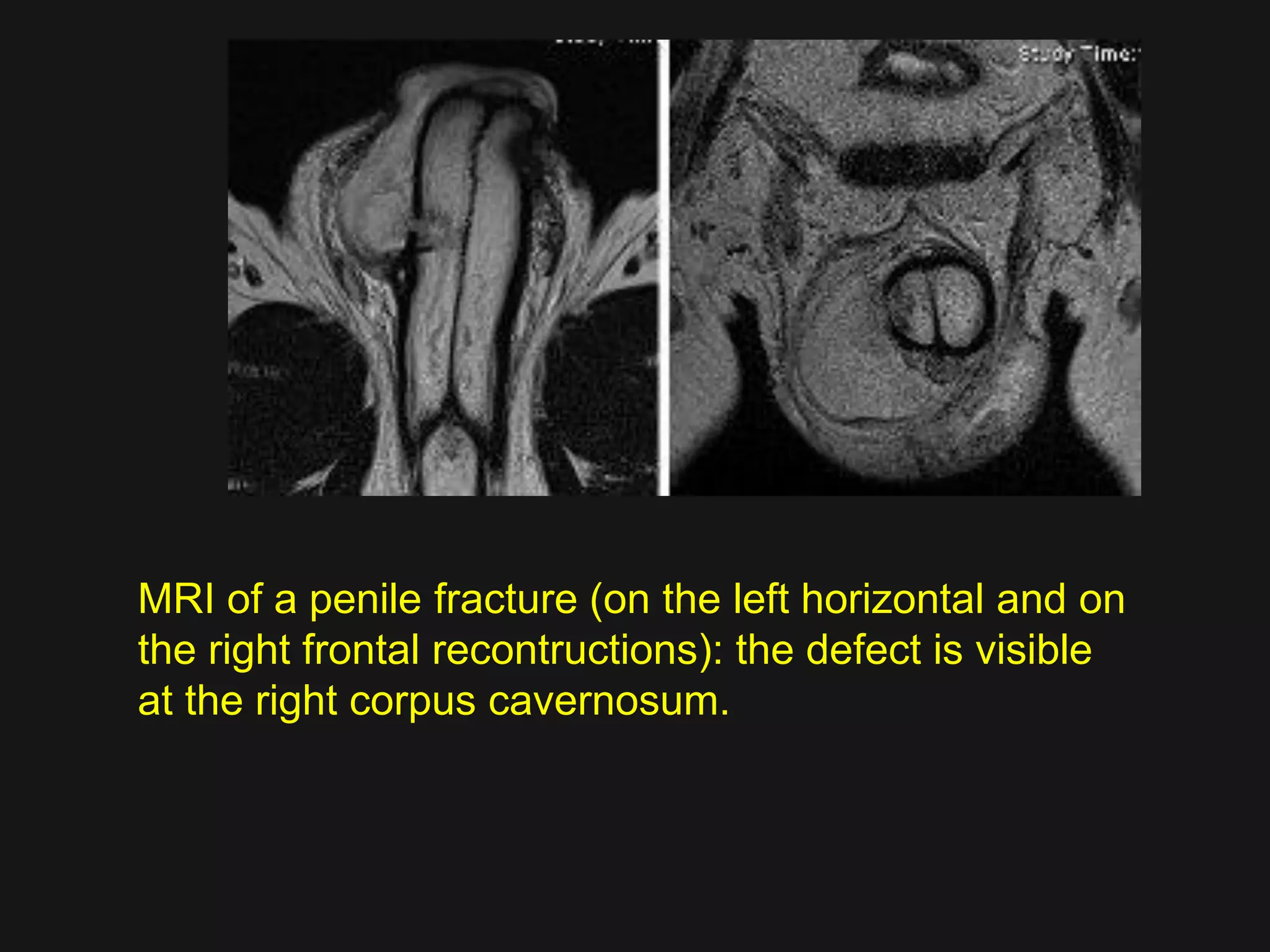 Imaging abdomen trauma male geniital part 10 Dr Ahmed Esawy | PDF