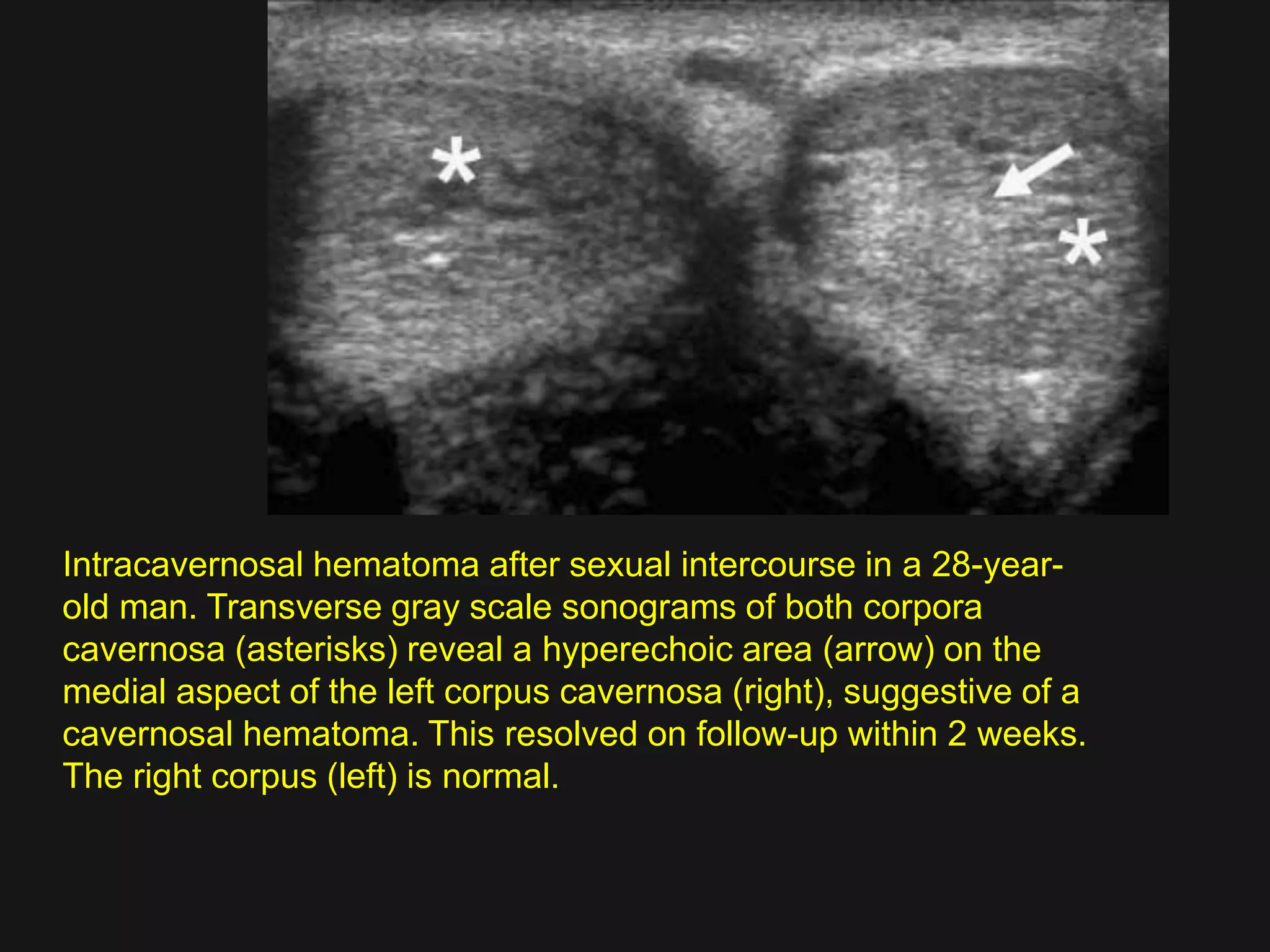 Imaging abdomen trauma male geniital part 10 Dr Ahmed Esawy | PDF