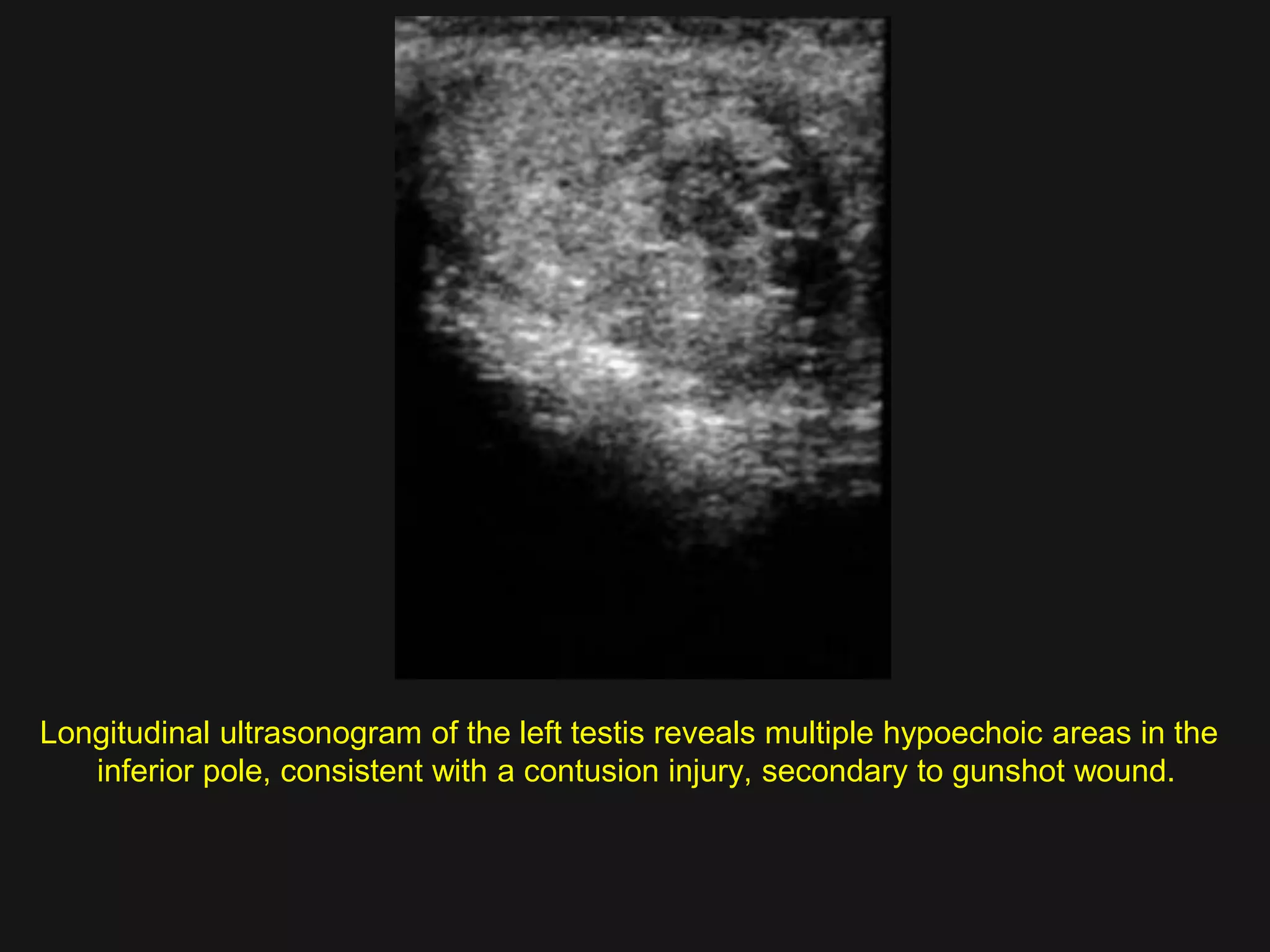 Imaging abdomen trauma male geniital part 10 Dr Ahmed Esawy | PDF