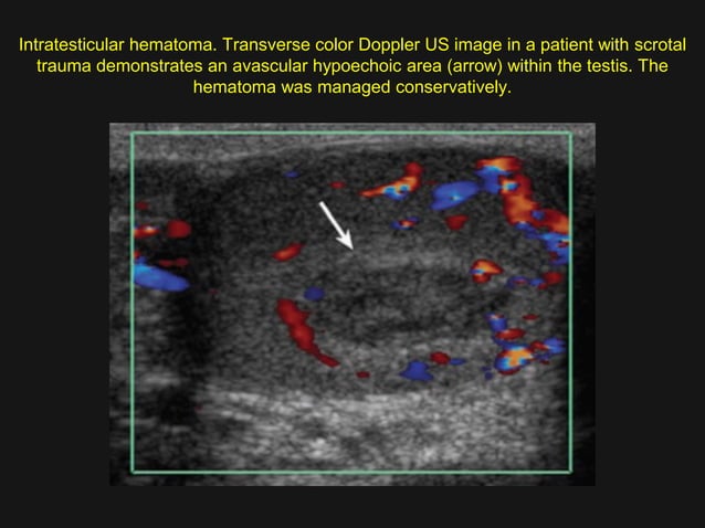 Imaging abdomen trauma male geniital part 10 Dr Ahmed Esawy | PDF