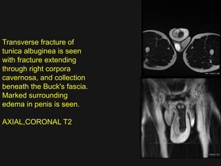 Imaging abdomen trauma male geniital part 10 Dr Ahmed Esawy | PDF