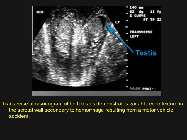 Imaging abdomen trauma male geniital part 10 Dr Ahmed Esawy | PDF