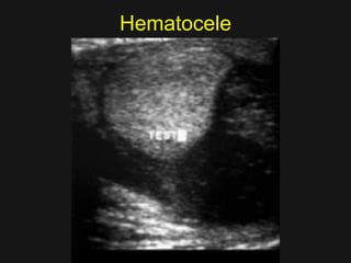 Imaging abdomen trauma male geniital part 10 Dr Ahmed Esawy | PDF