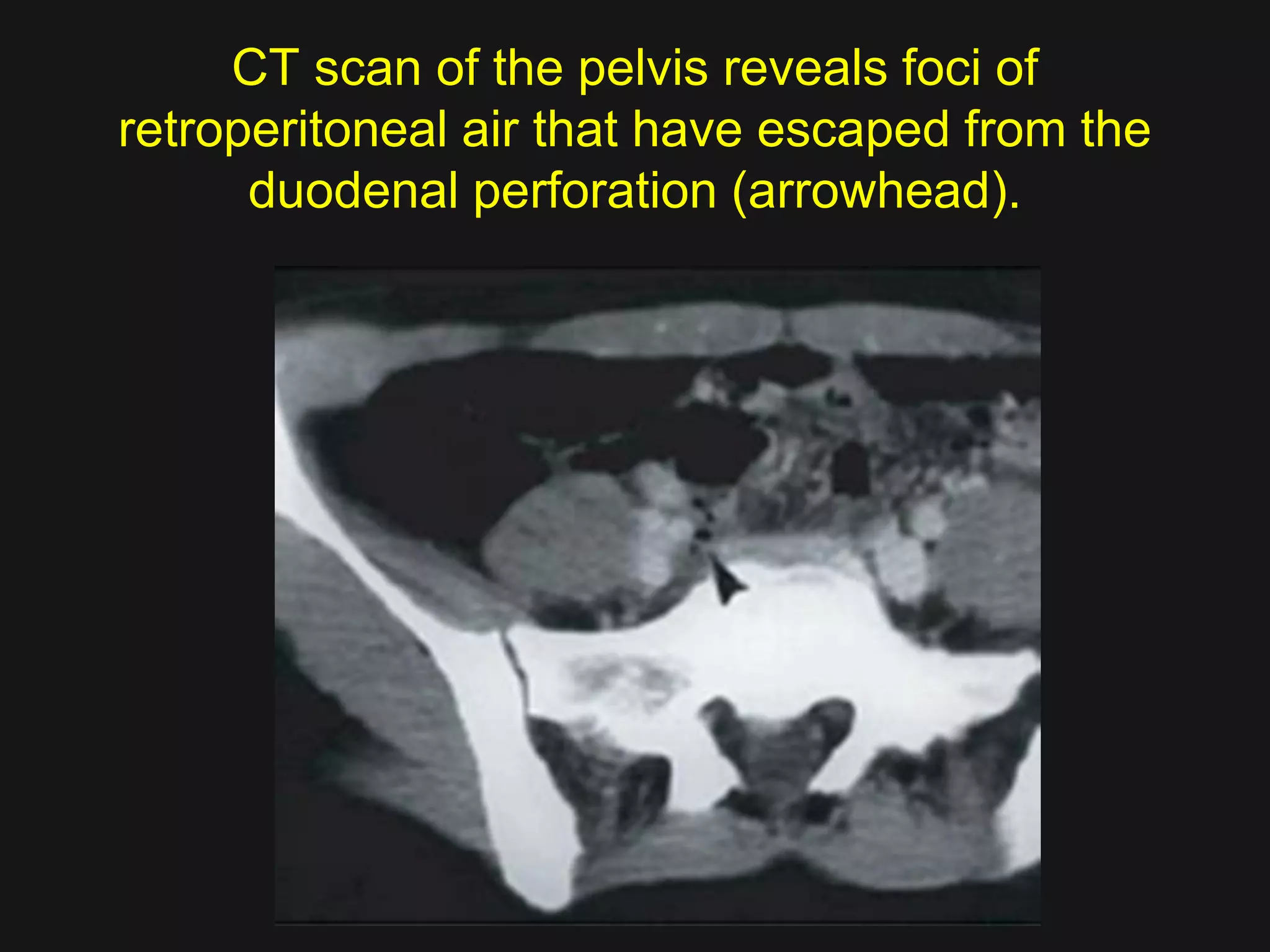 Imaging abdomen trauma mesenteric bowel trauma part 6 Dr Ahmed Esawy | PPT