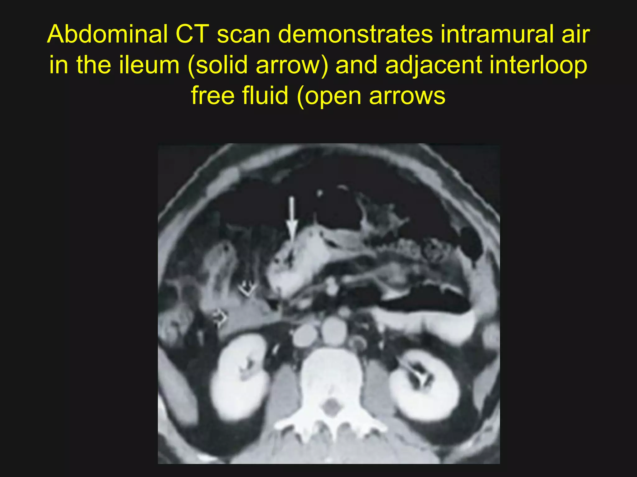 Imaging abdomen trauma mesenteric bowel trauma part 6 Dr Ahmed Esawy | PPT