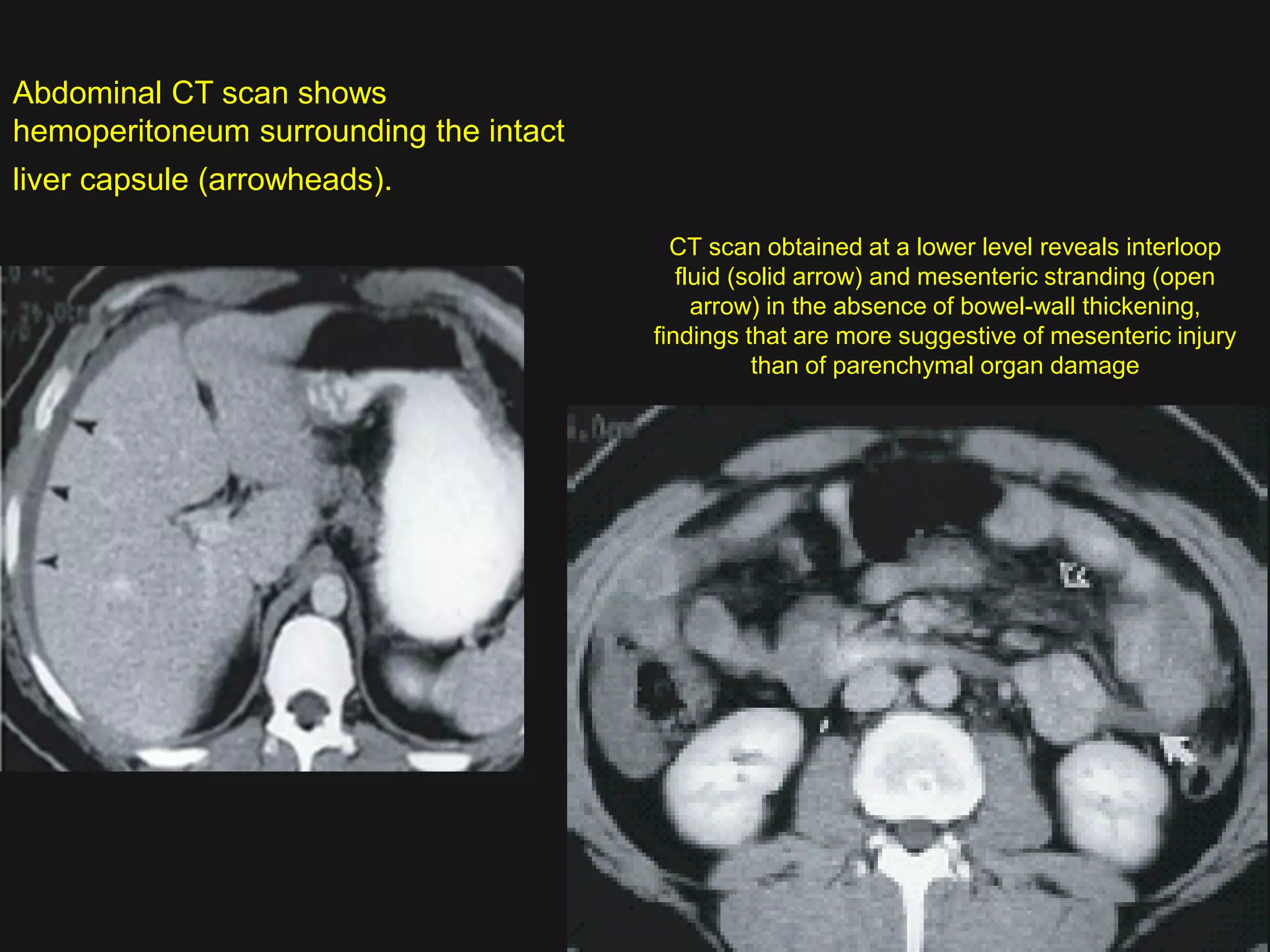 Imaging abdomen trauma mesenteric bowel trauma part 6 Dr Ahmed Esawy | PPT