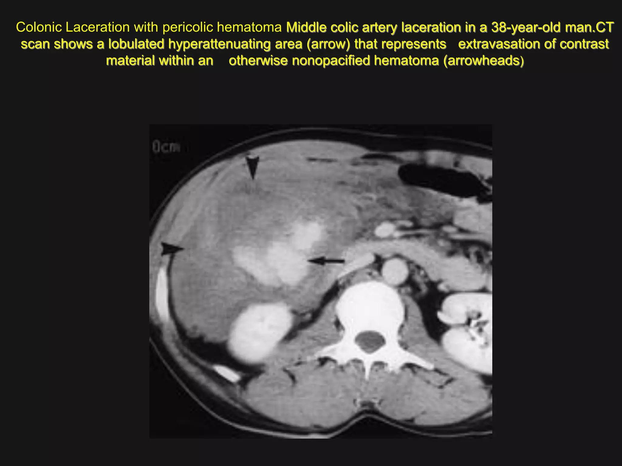 Imaging abdomen trauma mesenteric bowel trauma part 6 Dr Ahmed Esawy | PPT
