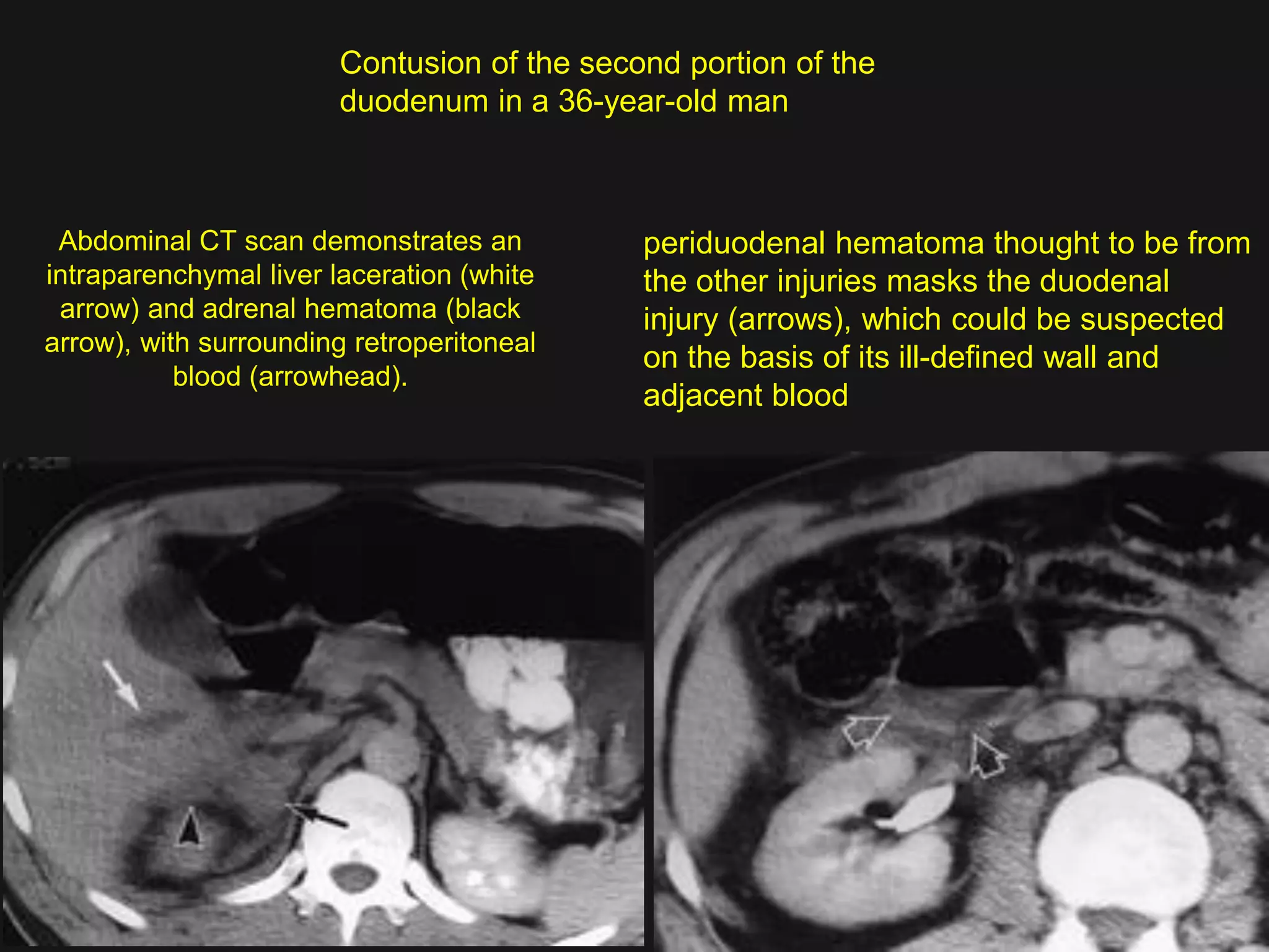 Imaging abdomen trauma mesenteric bowel trauma part 6 Dr Ahmed Esawy | PPT