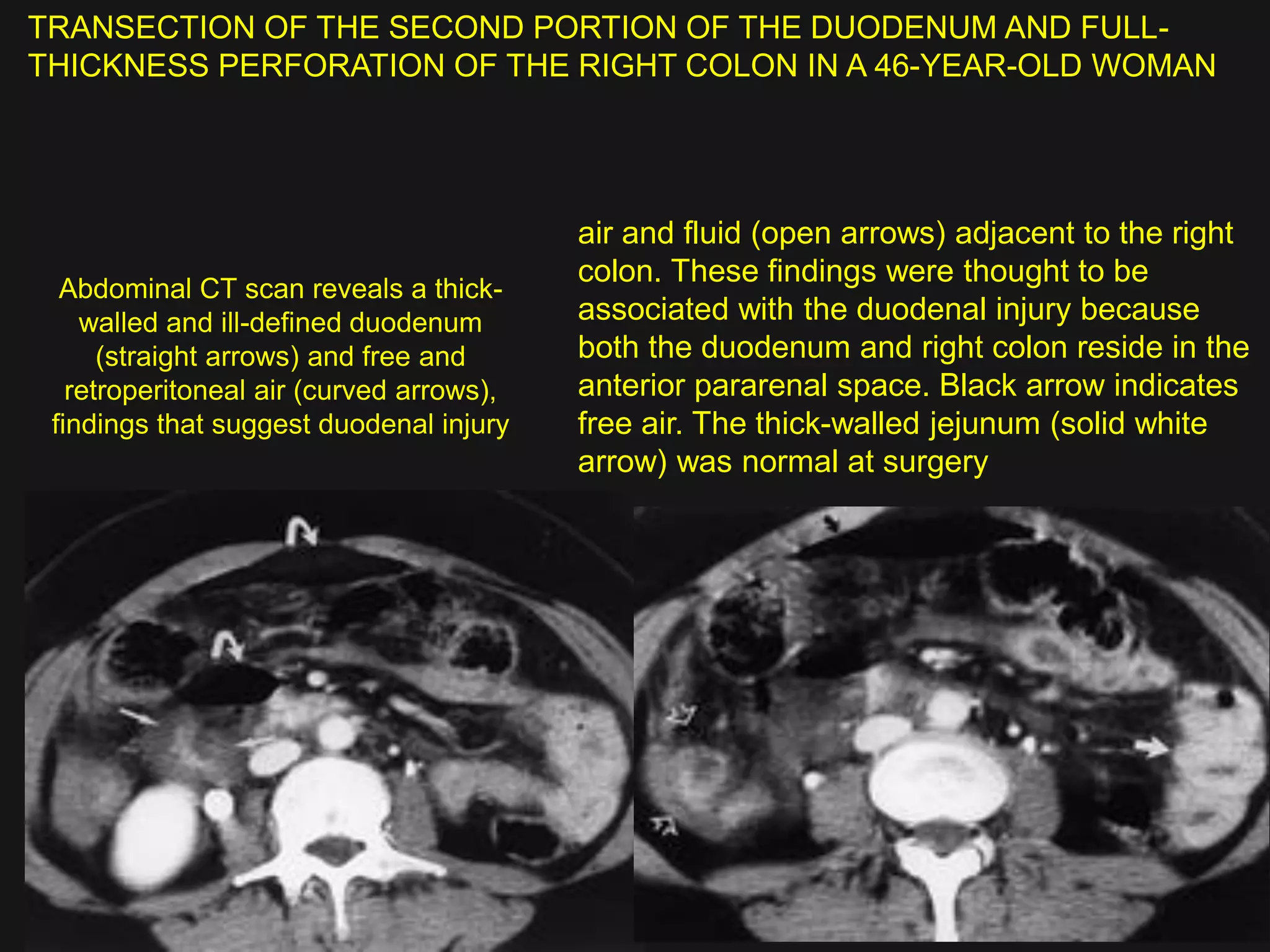 Imaging abdomen trauma mesenteric bowel trauma part 6 Dr Ahmed Esawy | PPT